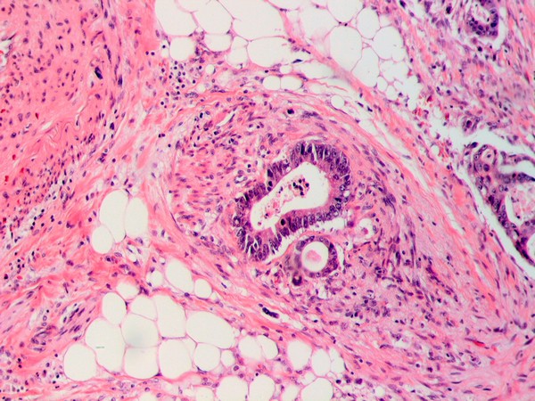 Study reveals early family history-based screening of colorectal cancer ...